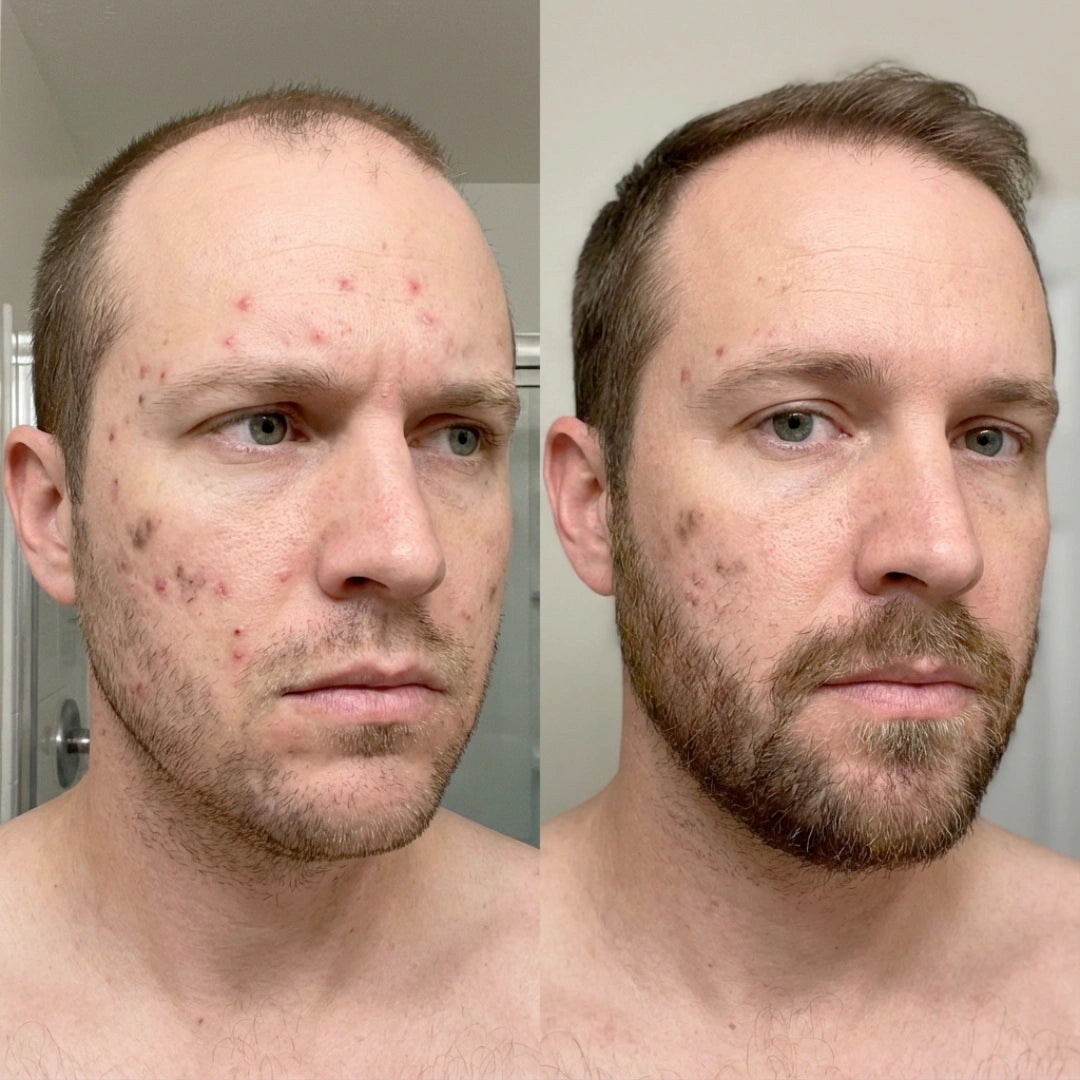 ClearFace™ - Acne & Redness Relief Balm – Rectivi